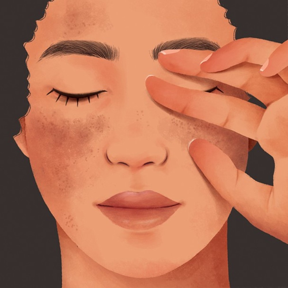 Melasma: conheça as causas, os sintomas e o tratamento