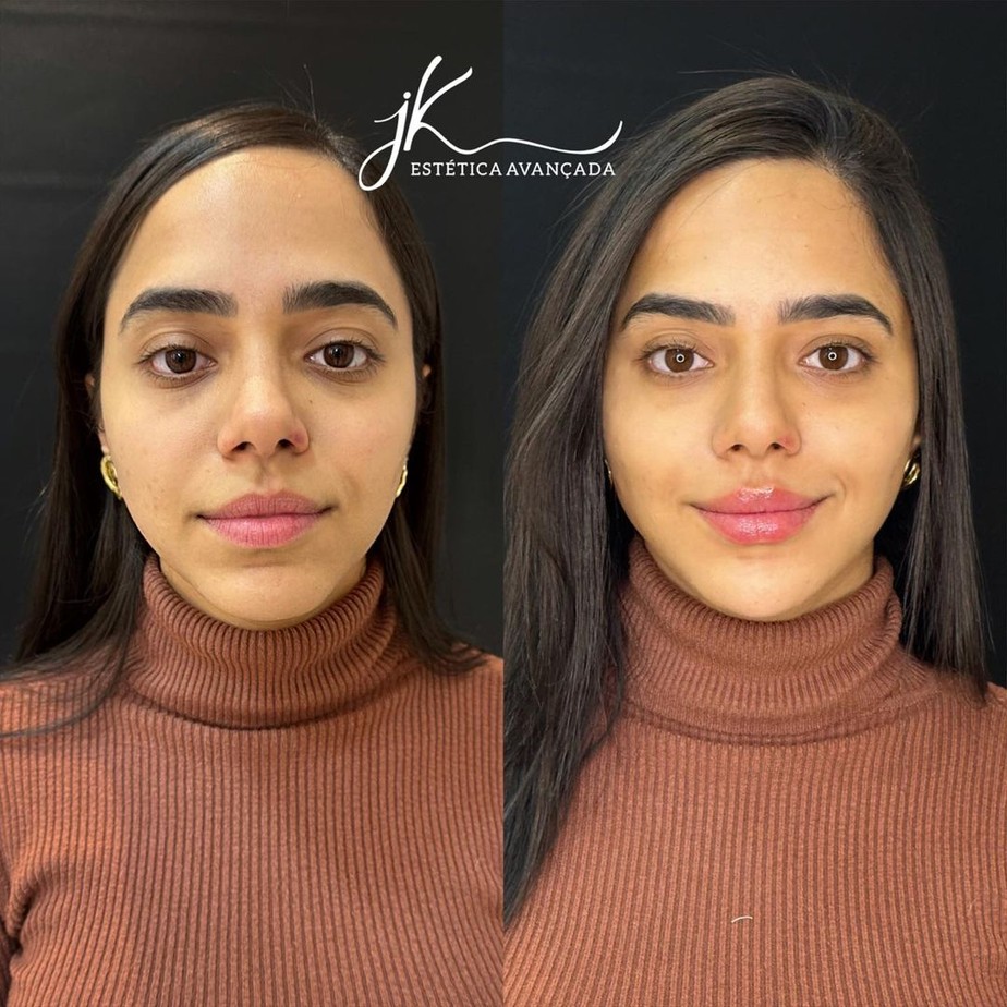 Mariely Santos, uma das Gêmeas da Lacração, faz harmonização facial ...