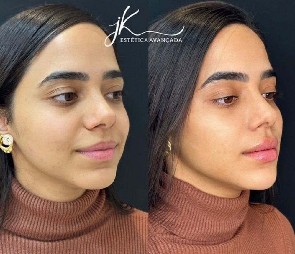 Mariely Santos, uma das Gêmeas da Lacração, faz harmonização facial