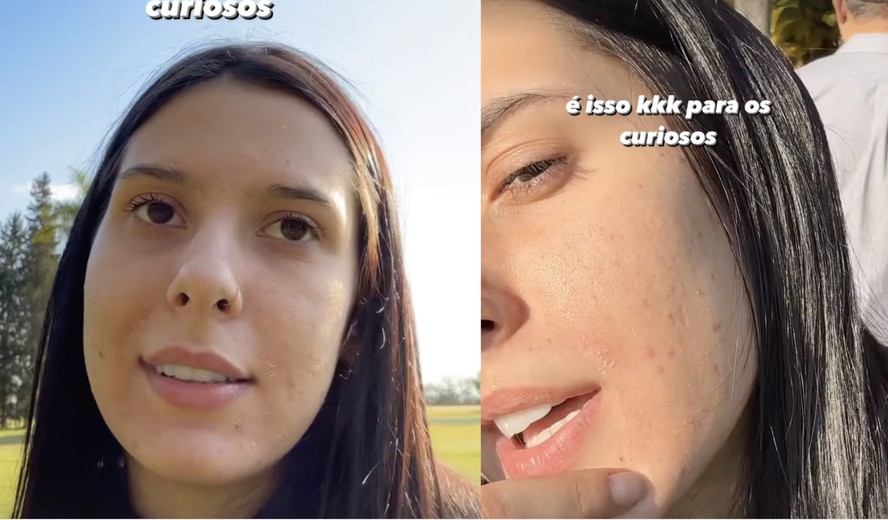 Ana Castela explica descamação na pele do rosto: 'tratamento para espinha'