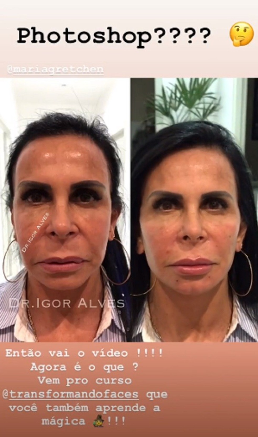 Após harmonização facial, Gretchen posta sobre uso de Photoshop
