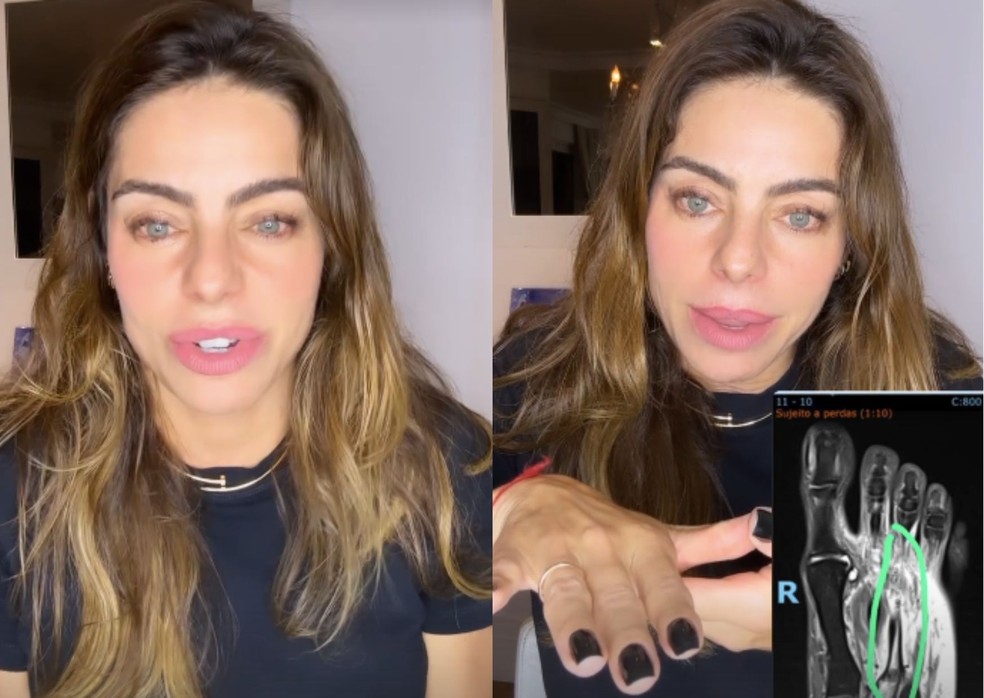 Daniella Cicarelli revela que correu 22km com pé quebrado: 'Fiquei até ...