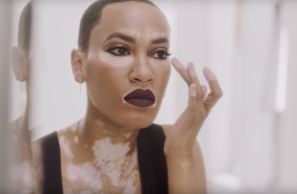 Modelo com vitiligo protagoniza nova campanha de base da CoverGirl