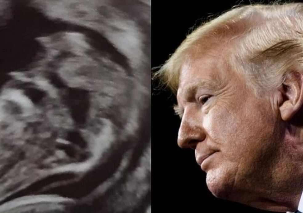 Mãe faz ultrassom e fica chocada ao perceber que bebê parece Trump