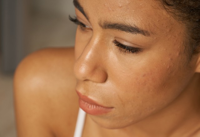 Tipos de acne: conheça os 4 graus e saiba como cuidar