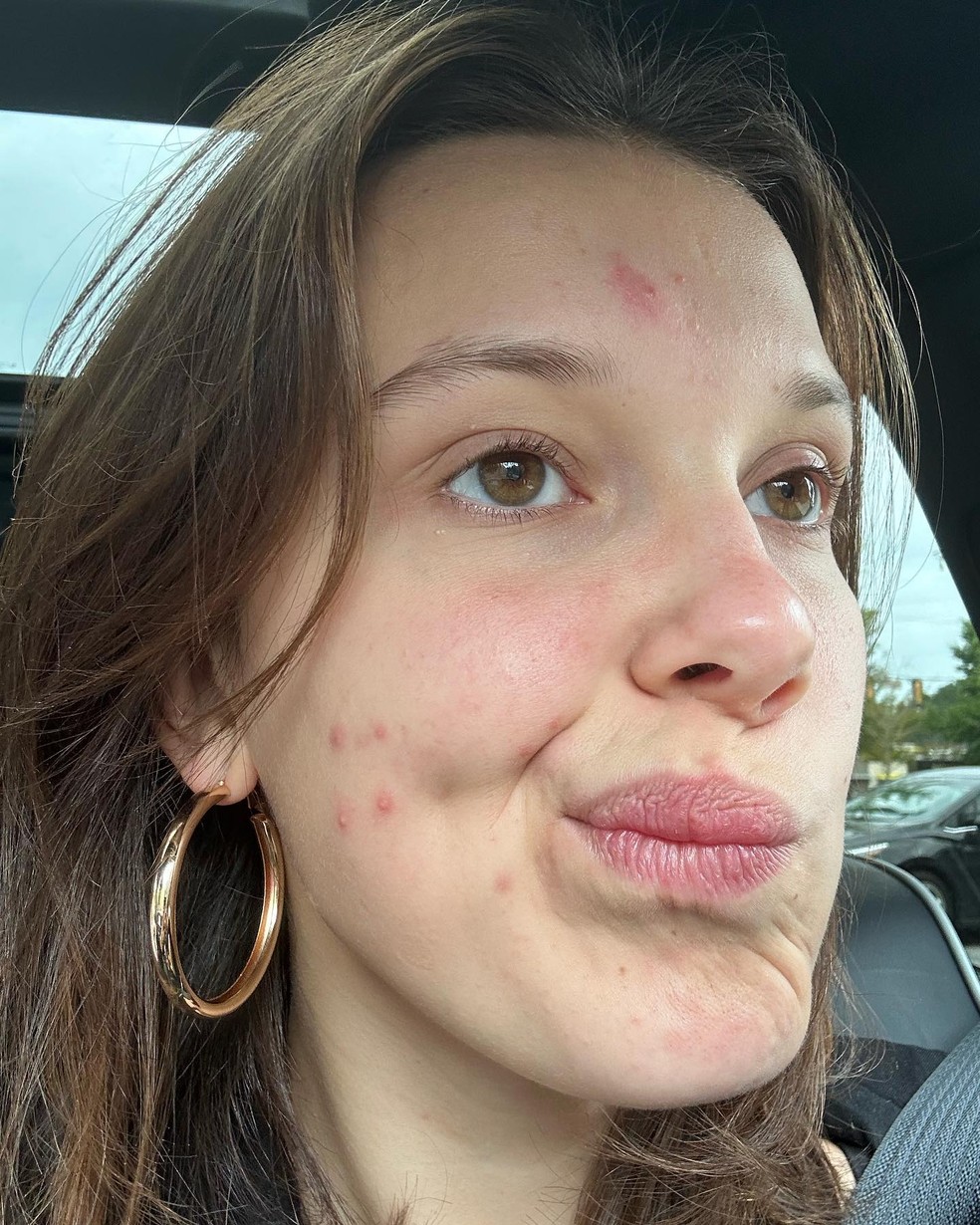 Millie Bobby Brown dispensa maquiagem e expõe acne no rosto