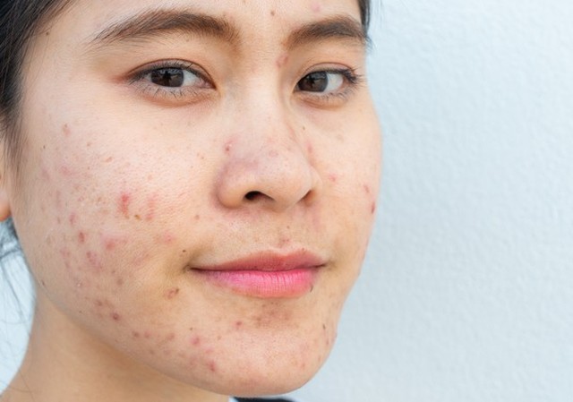 Roacutan: tudo o que você precisa saber sobre o medicamento