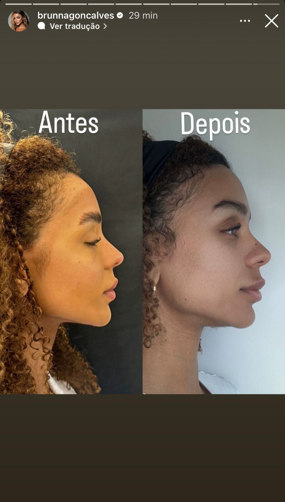 Brunna Gonçalves mostra antes e depois de frontoplastia