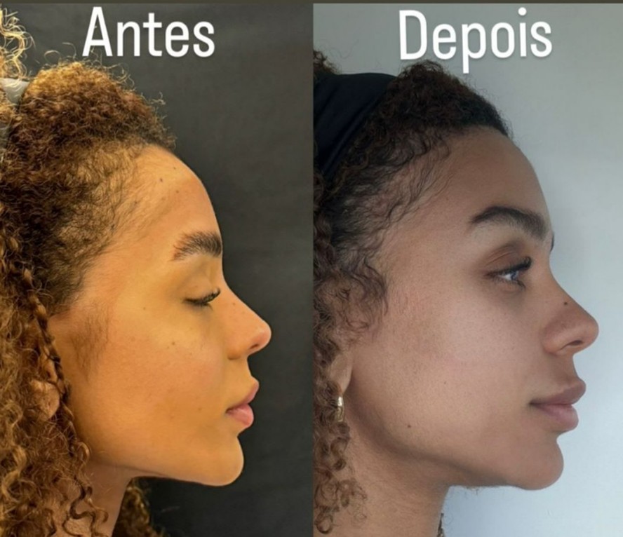 Brunna Gonçalves mostra antes e depois de frontoplastia
